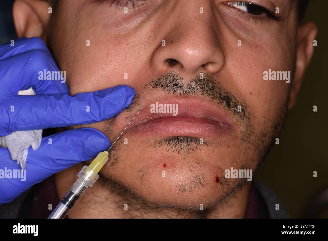 Doctor injecting the anti-inflammatory steroid triamcinolone acetonide ...