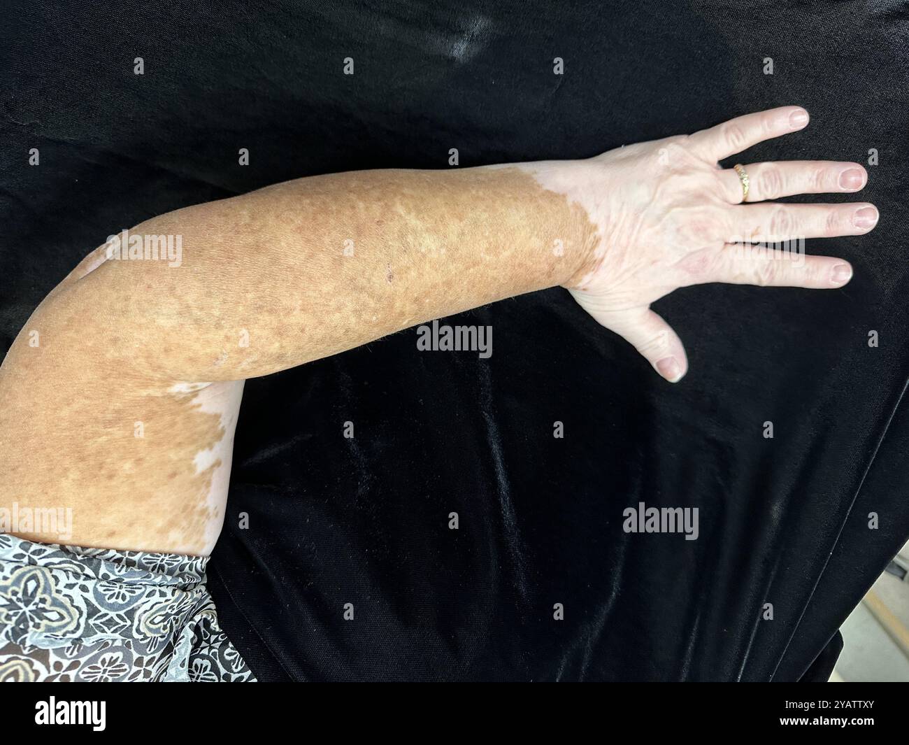 Trichrome vitiligo on the arm and hand of a Hispanic male patient ...