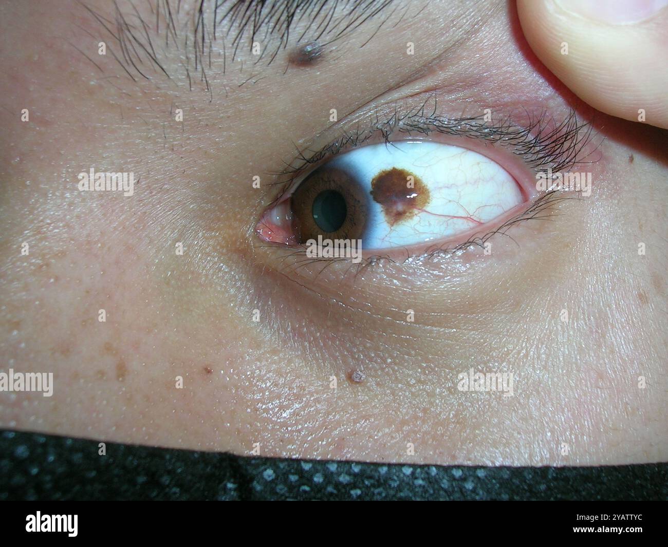 Eye of a patient with a benign (non-cancerous) naevus of the ...
