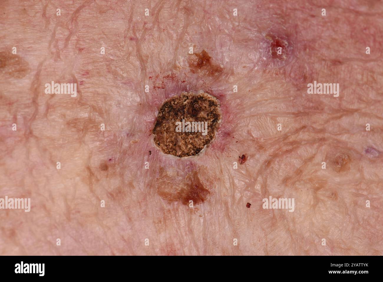 Lesion on the chest of a 72 year old white female patient with Bowen's ...