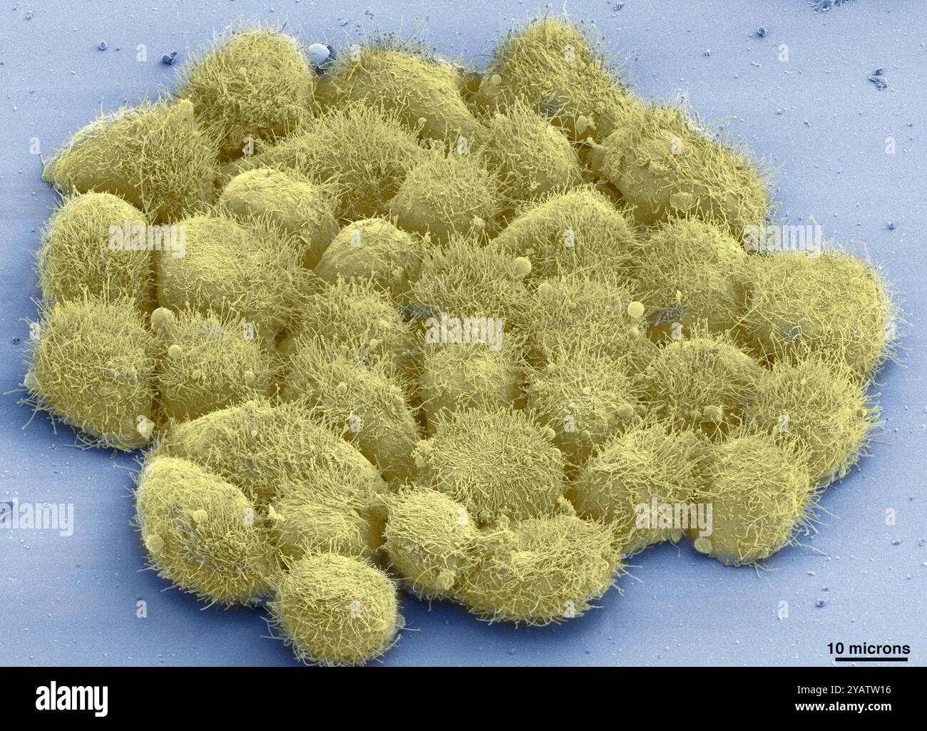 HeLa cells, coloured scanning electron micrograph (SEM). HeLa cells ...