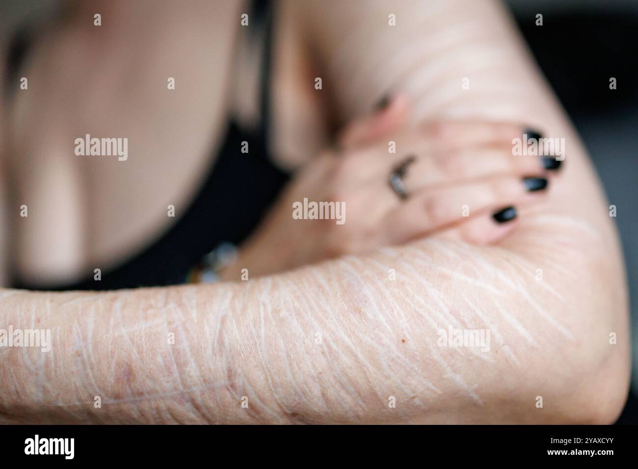 Scars arm hi-res stock photography and images - Alamy