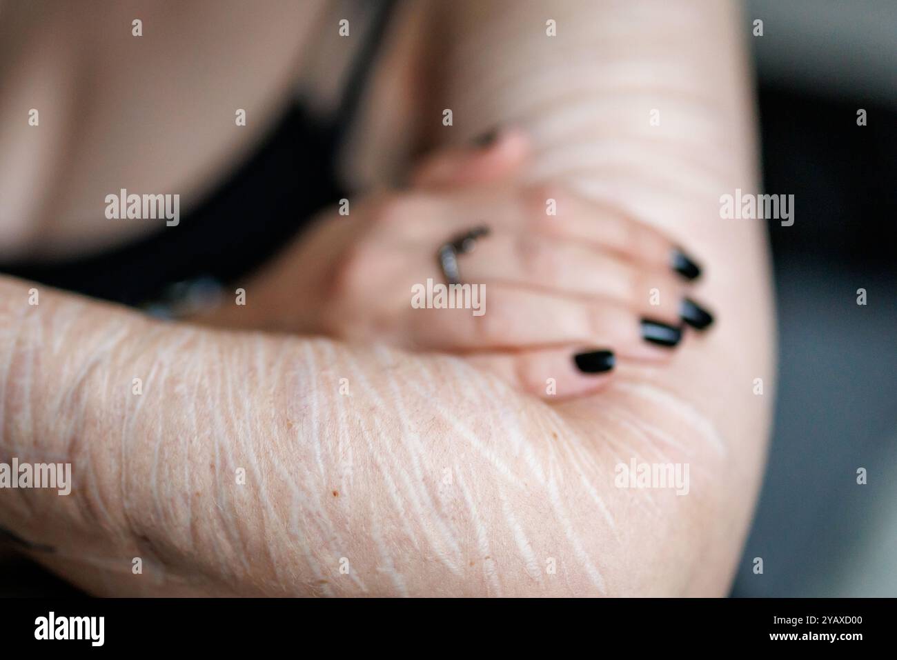 Scars arm hi-res stock photography and images - Alamy