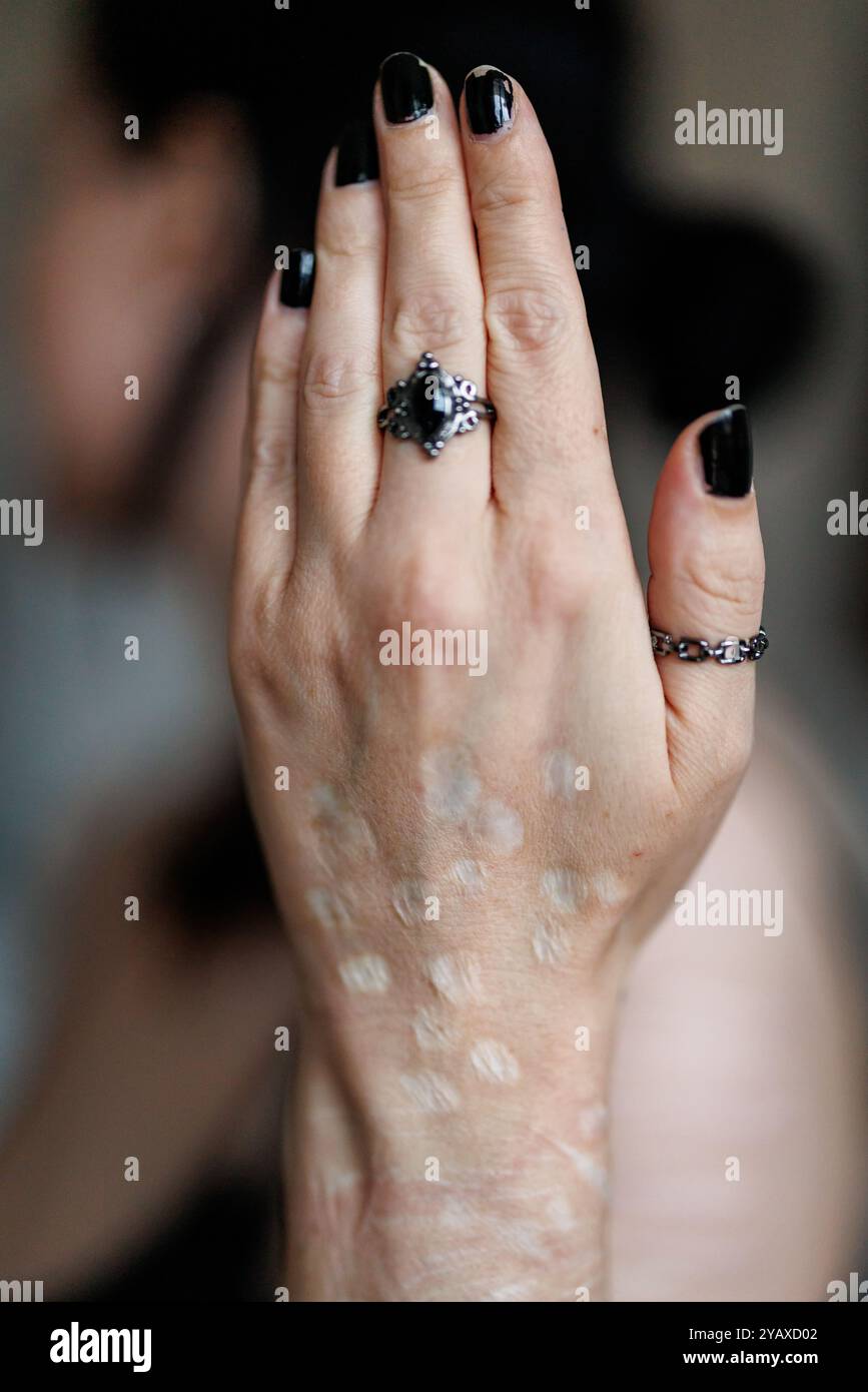 Nuremberg, Germany. 10th Oct, 2024. A victim of self-harming behavior ...