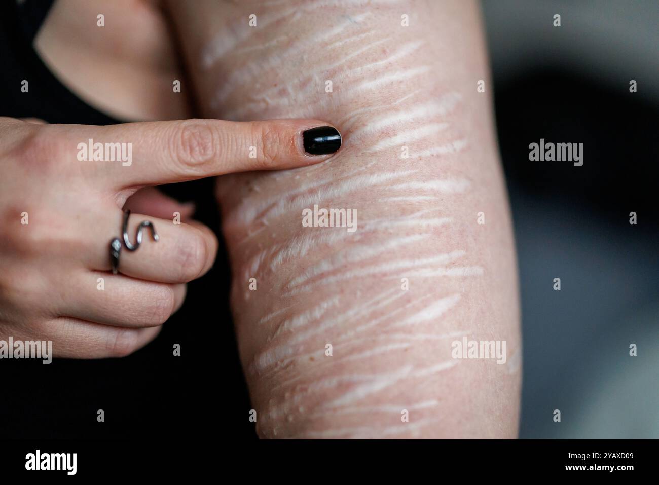 Scars arm hi-res stock photography and images - Alamy
