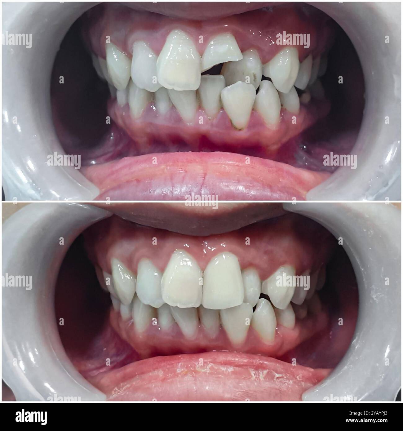 A successful dental restoration, highlighting the transformation of a ...