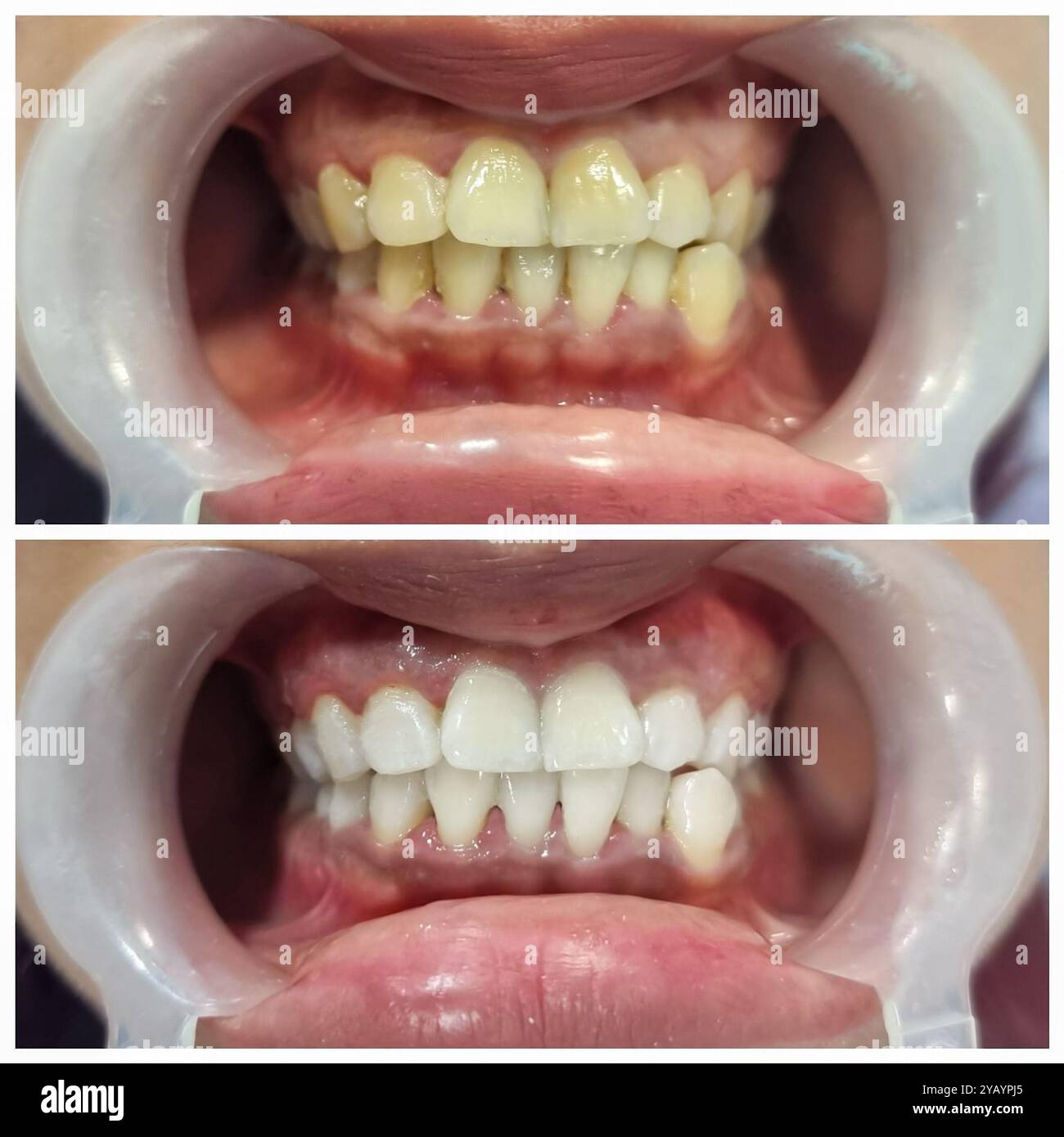 Before and after scaling and polishing treatment for yellow stains on ...