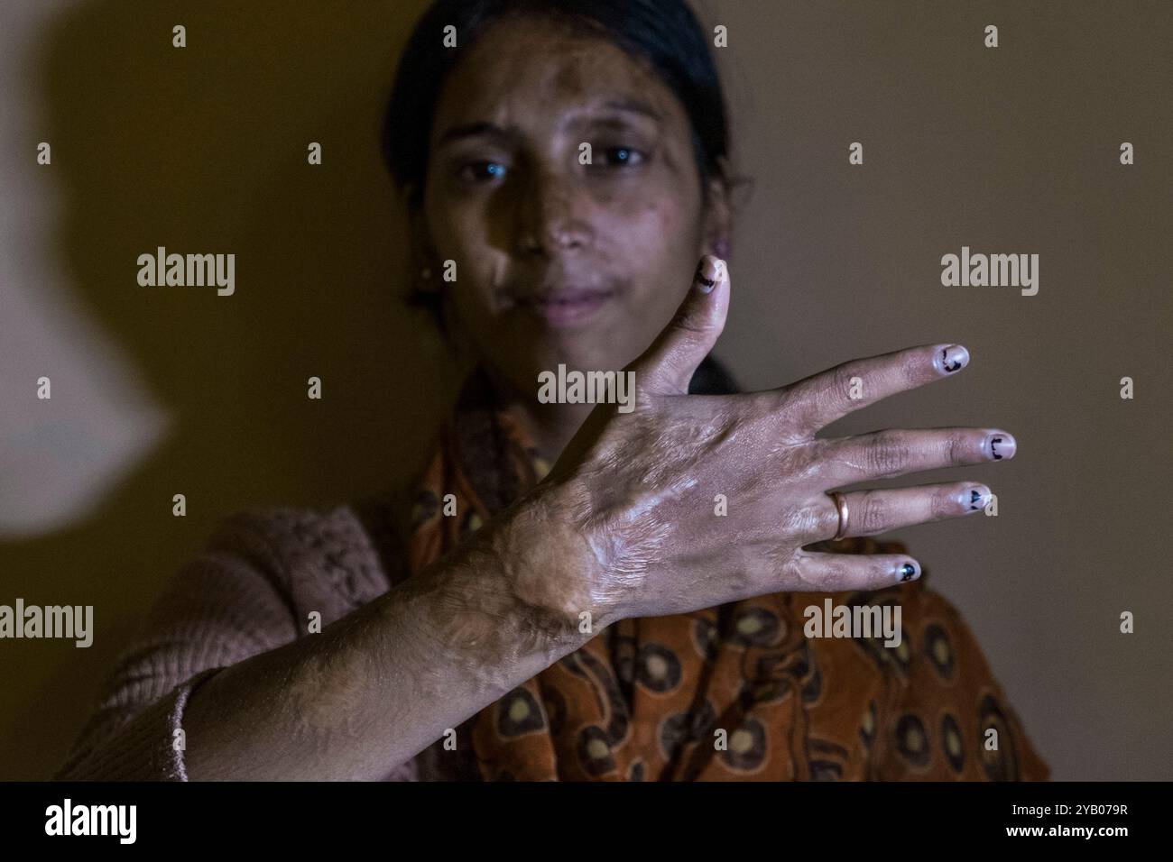 Acid victim india hi-res stock photography and images - Alamy