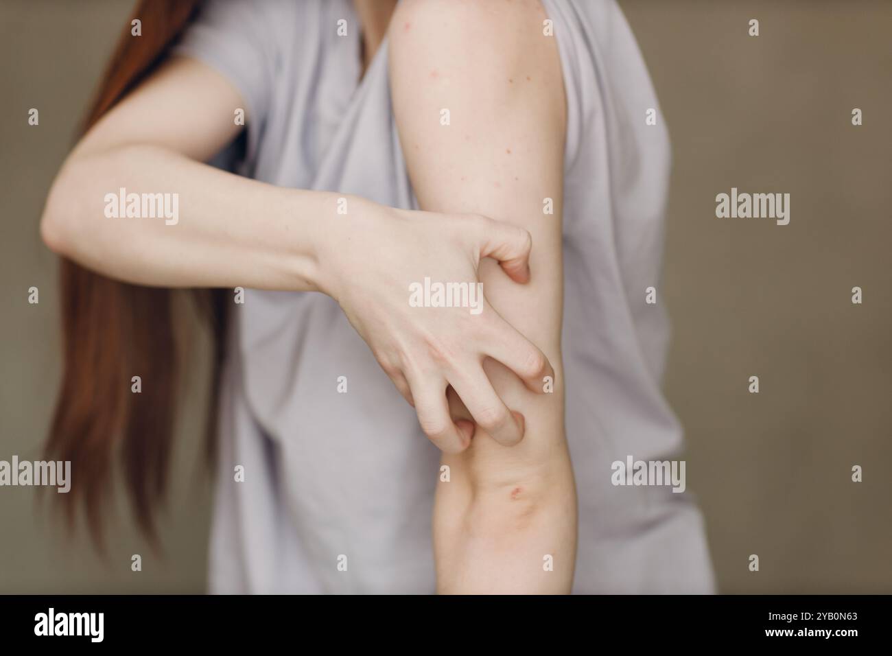 Allergy dermatology scabies itches hand skin problem woman Stock Photo ...