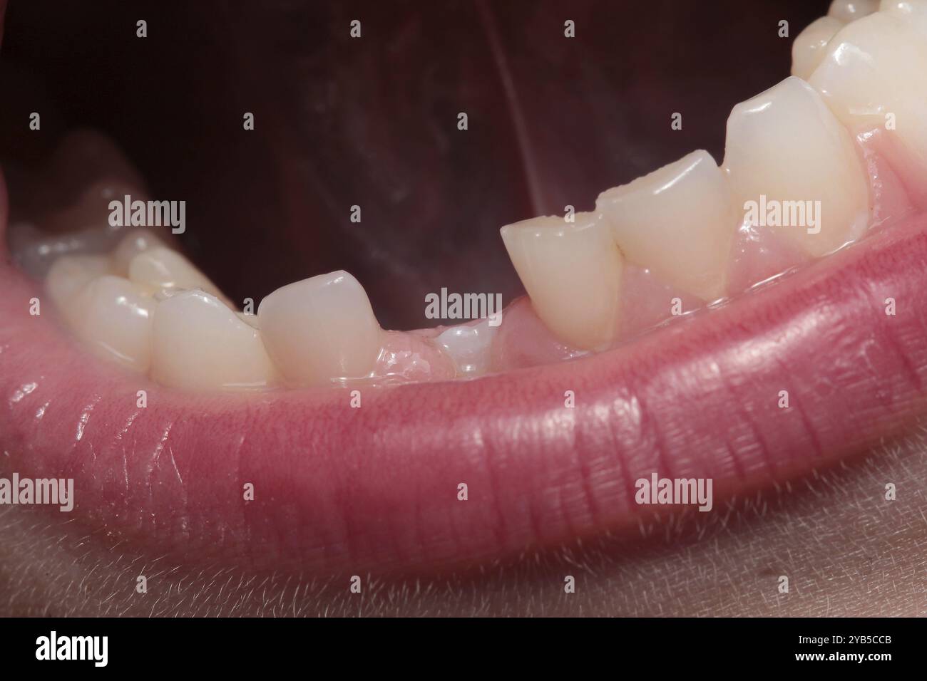 Tooth gap with a small renewable permanent tooth, Tooth with a small ...