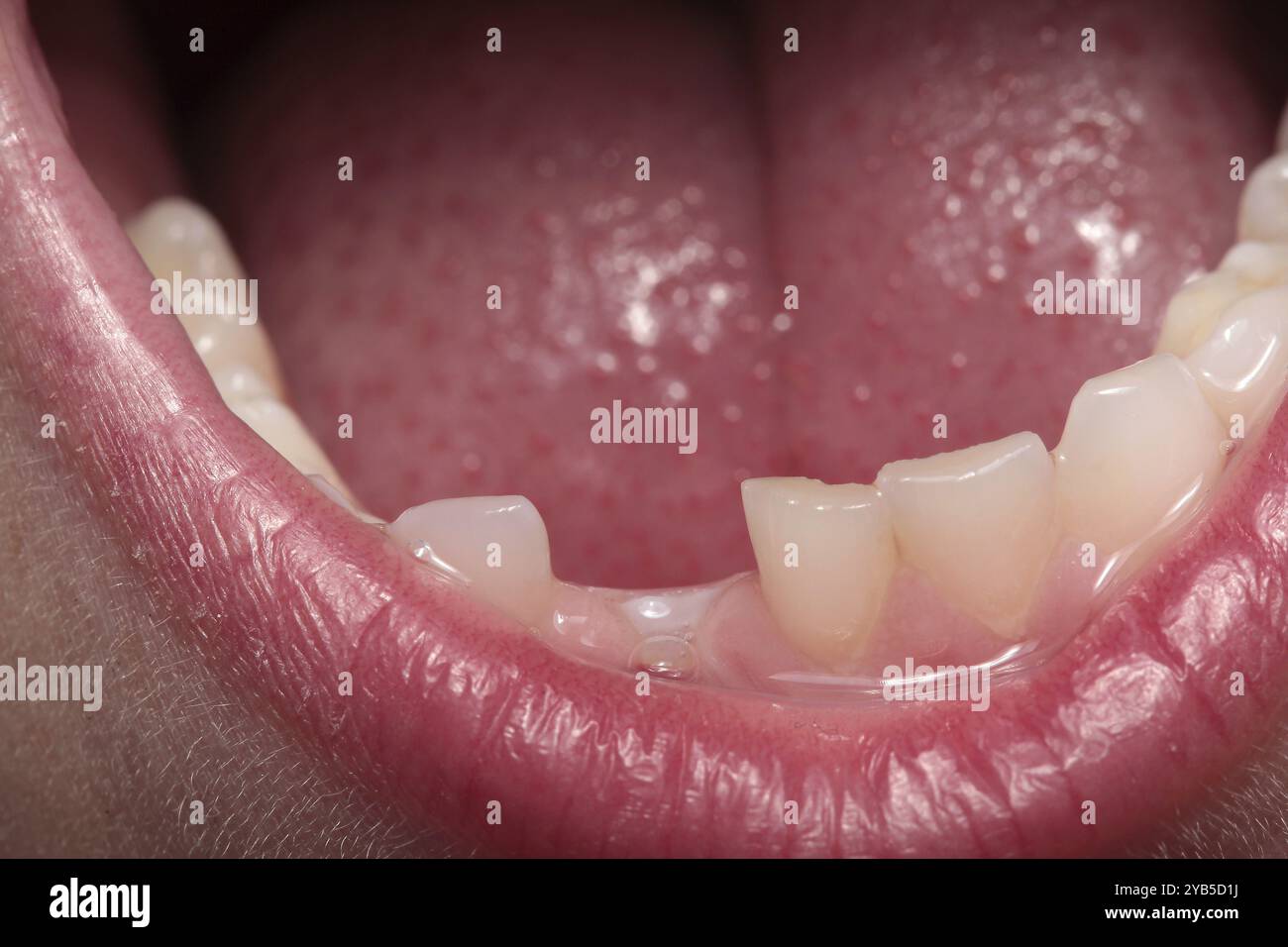 Tooth gap with a small renewable permanent tooth, Tooth with a small ...