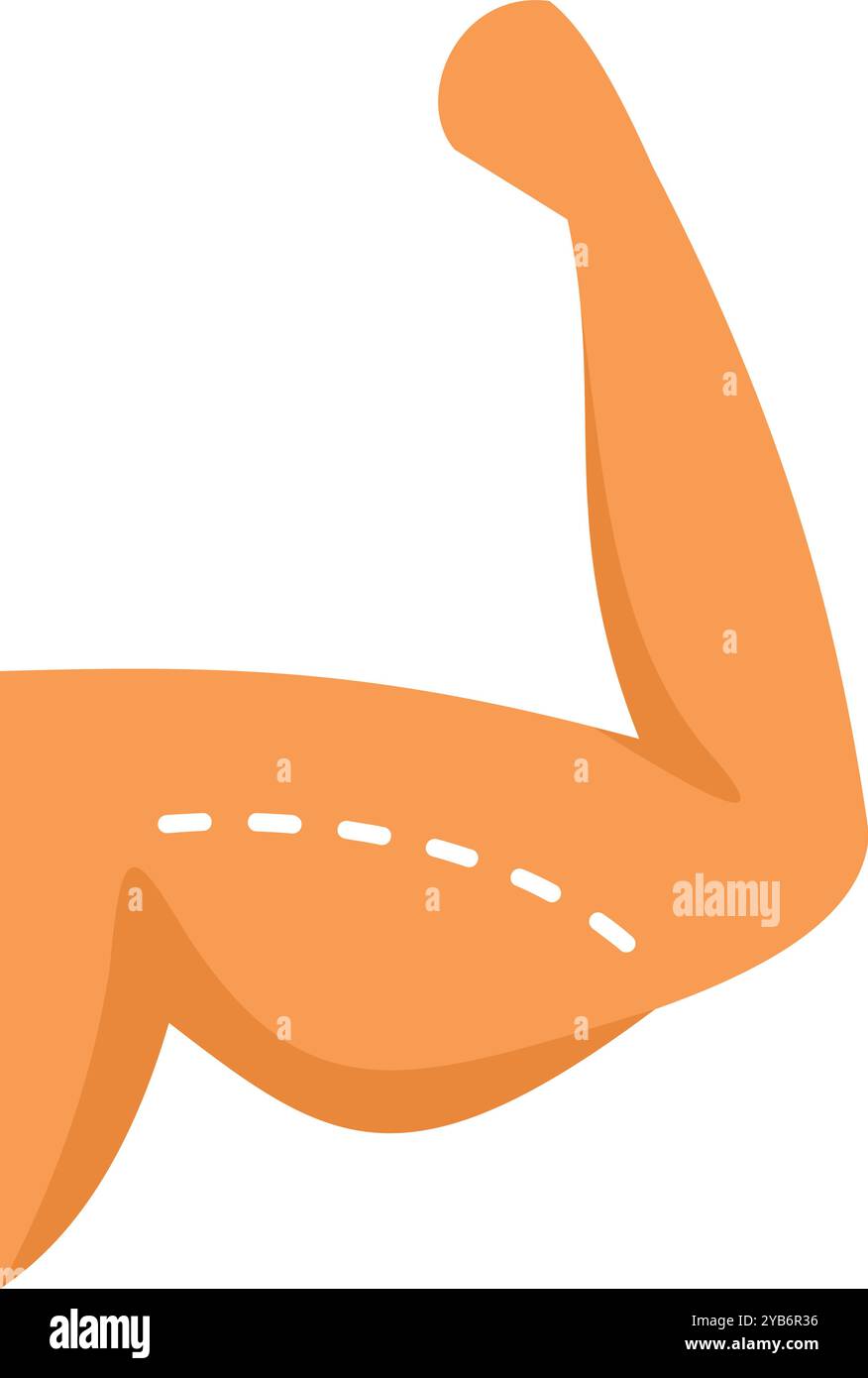 This illustration shows the result of an arm lift, a surgical procedure ...