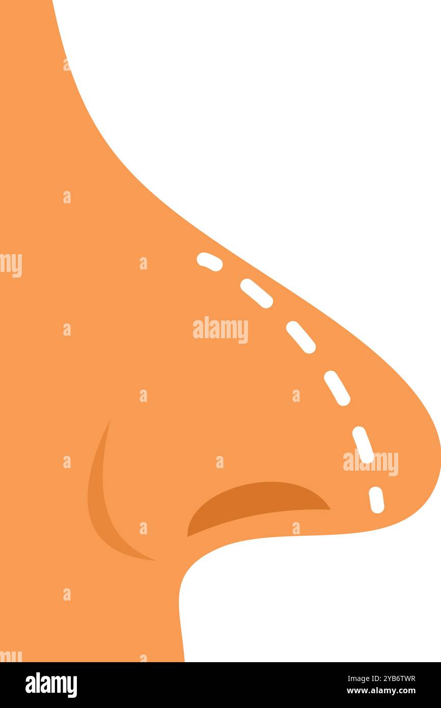 This illustration shows a rhinoplasty procedure being performed on a ...