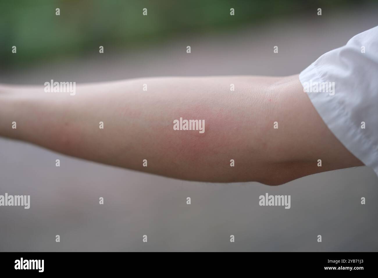 itchy mosquito bite on people's arm skin Stock Photo - Alamy