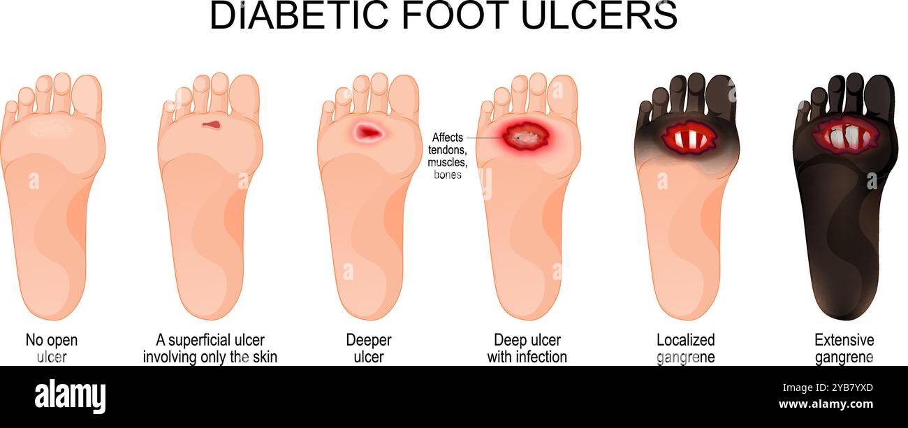 Diabetic foot ulcers. Classification of severity from risk of ulceration to Extensive gangrene ...