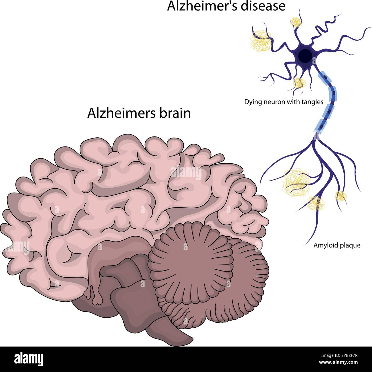 brain with Alzheimers disease Stock Vector Image & Art - Alamy