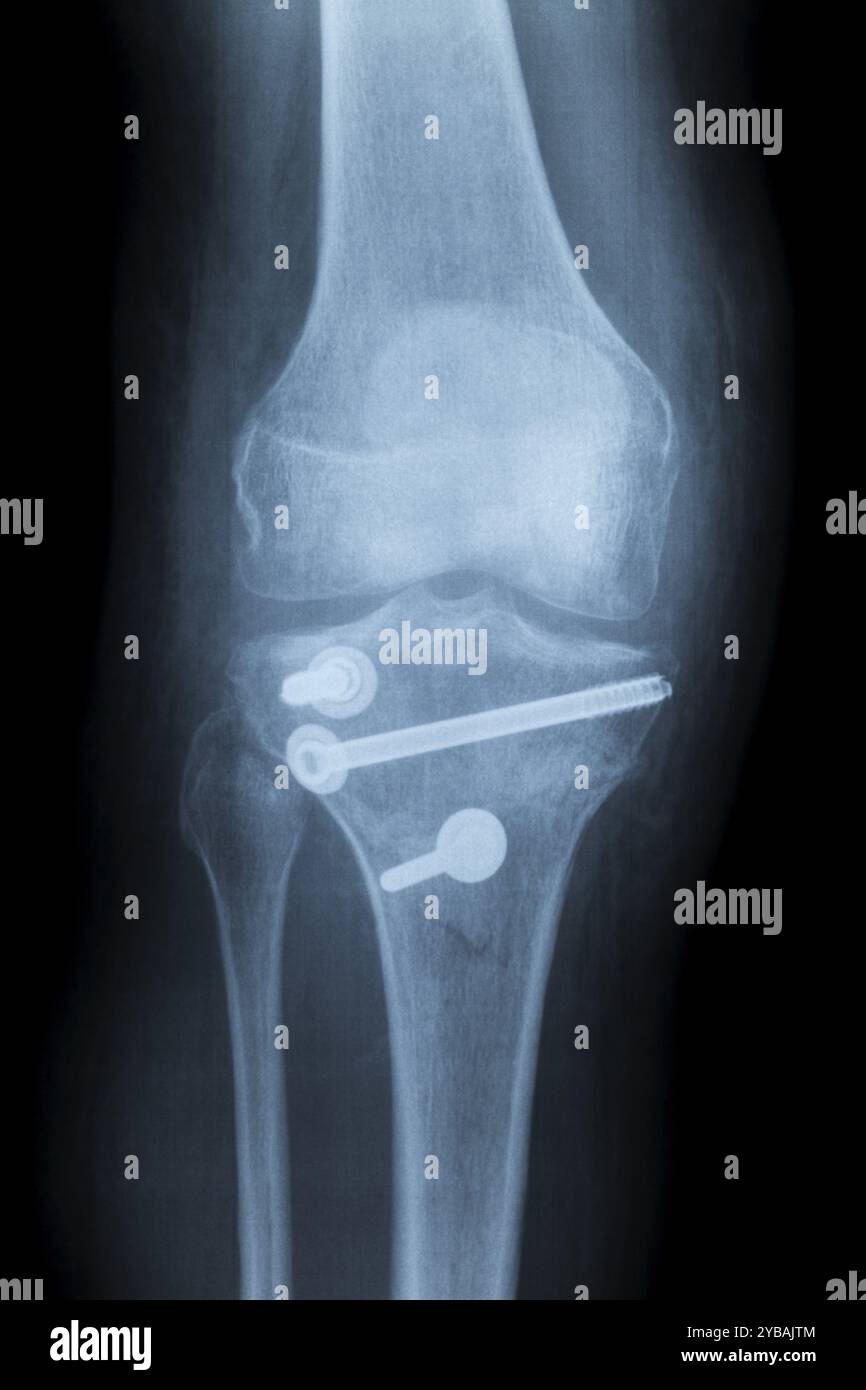 Right human knee anterior posterior, X-ray image after repositioning ...