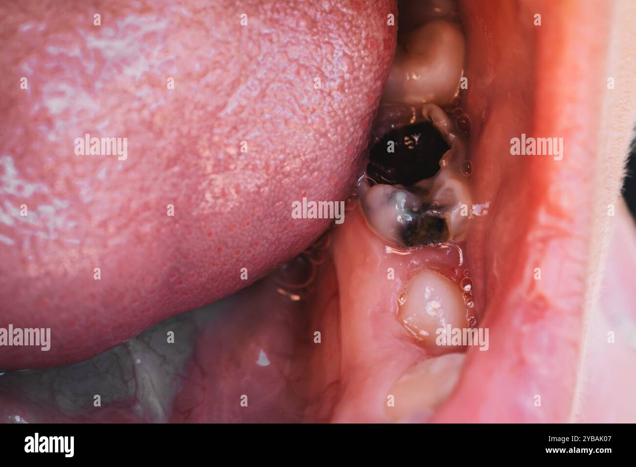 Child's open mouth. Problem in caries of baby teeth. Different stages ...
