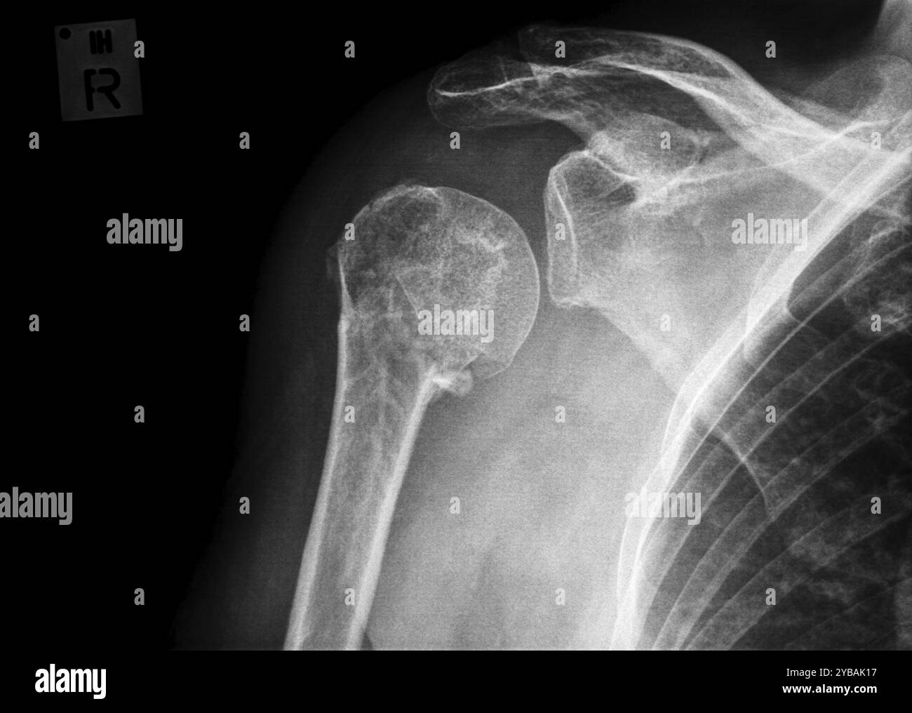 Right humeral fracture, anterior-posterior (ap) image using ...