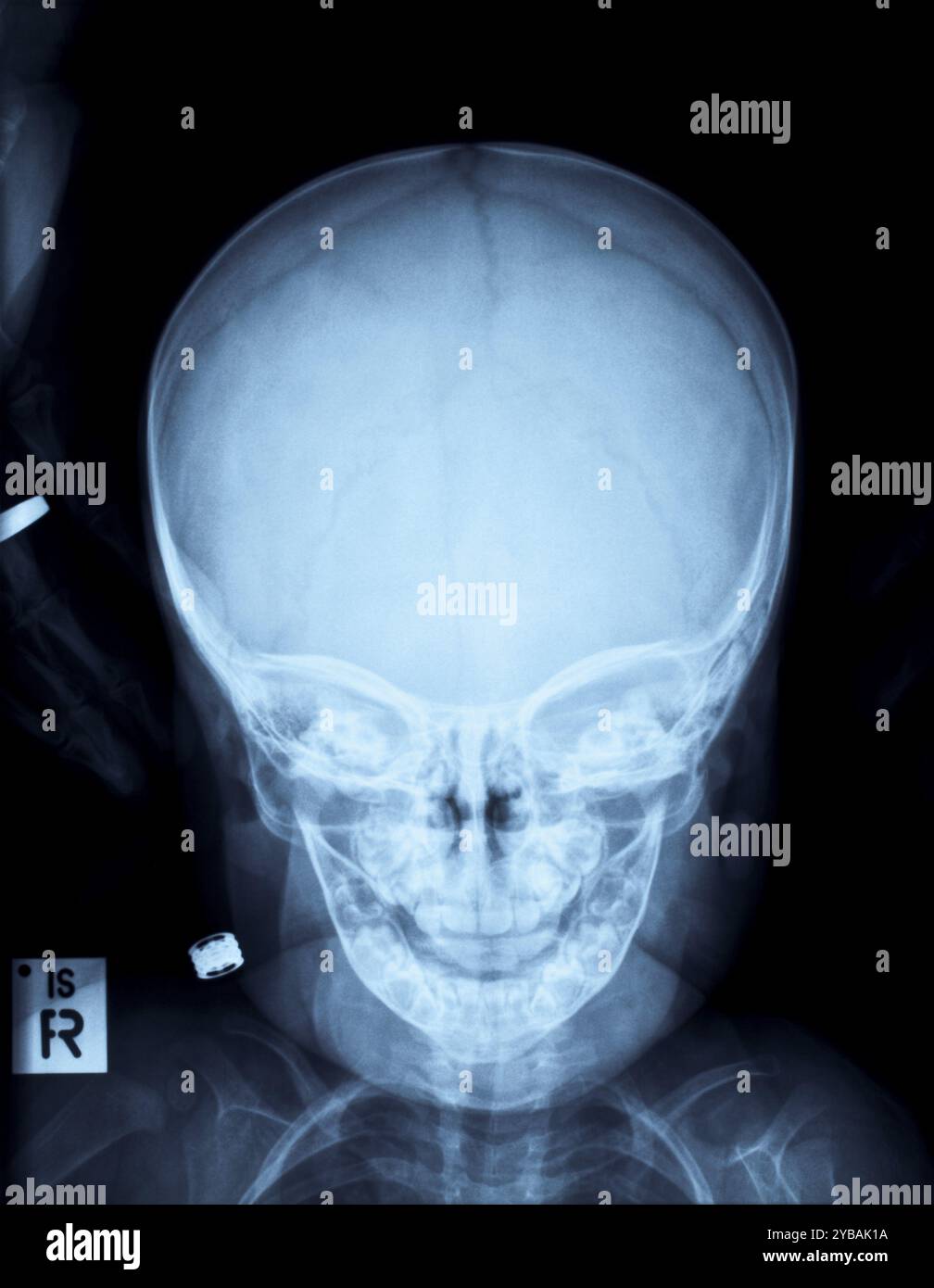 Child's skull, X-rays after accident without findings Stock Photo - Alamy