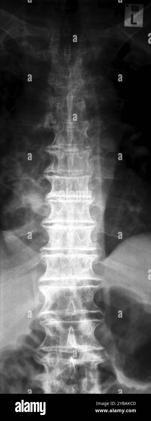 Thoracic spine, X-ray of an adult without findings Stock Photo - Alamy