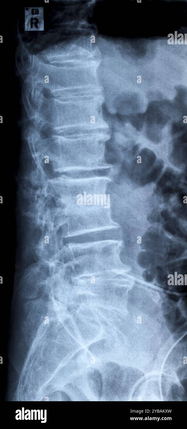 Herniated disc in the lumbar spine, x-ray image lateral/ Lumbar (spine ...