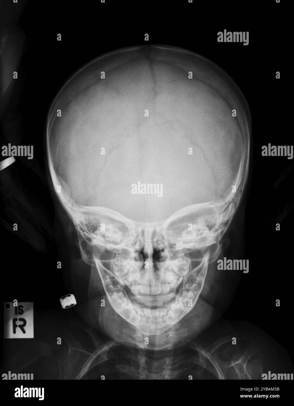 Child's skull, X-rays after accident without findings Stock Photo - Alamy