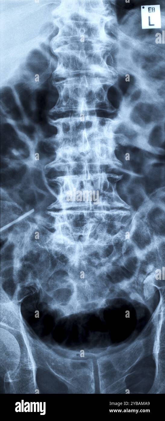 Lumbar disc herniation (ldh), disc prolapse, lumbar spine, human x-ray ...