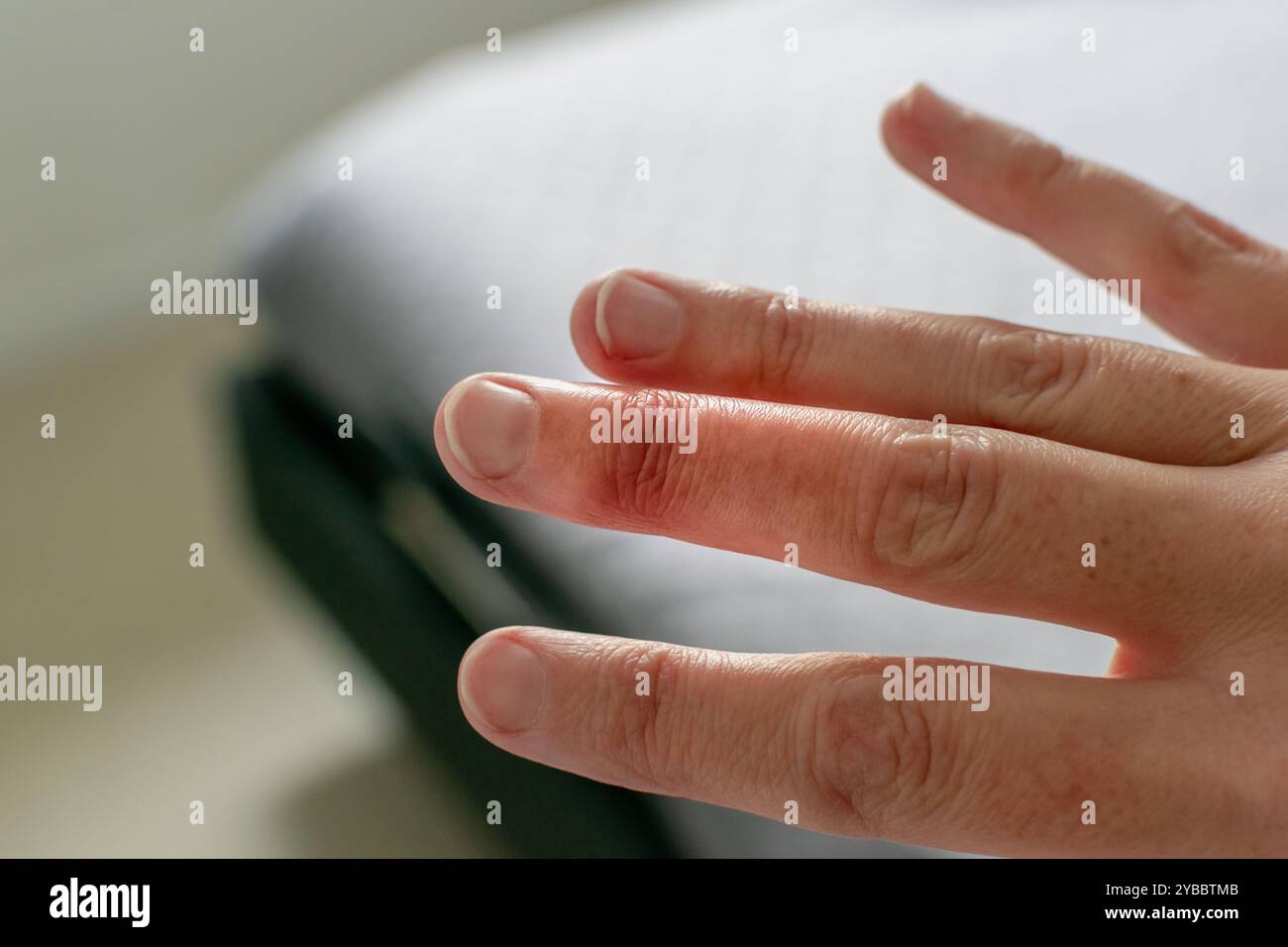 Mallet finger healing after splint removal from middle finger following ...