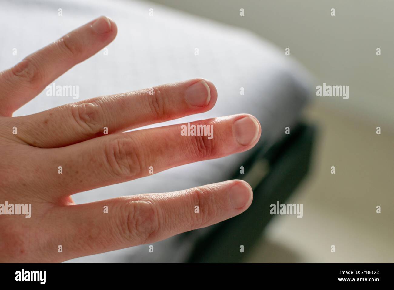 Mallet finger healing after splint removal from middle finger following ...