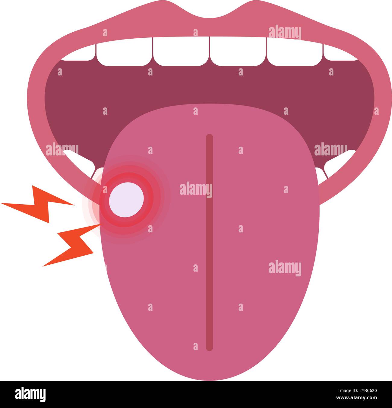Mouth with canker sore. Editable vector Stock Vector Image & Art - Alamy