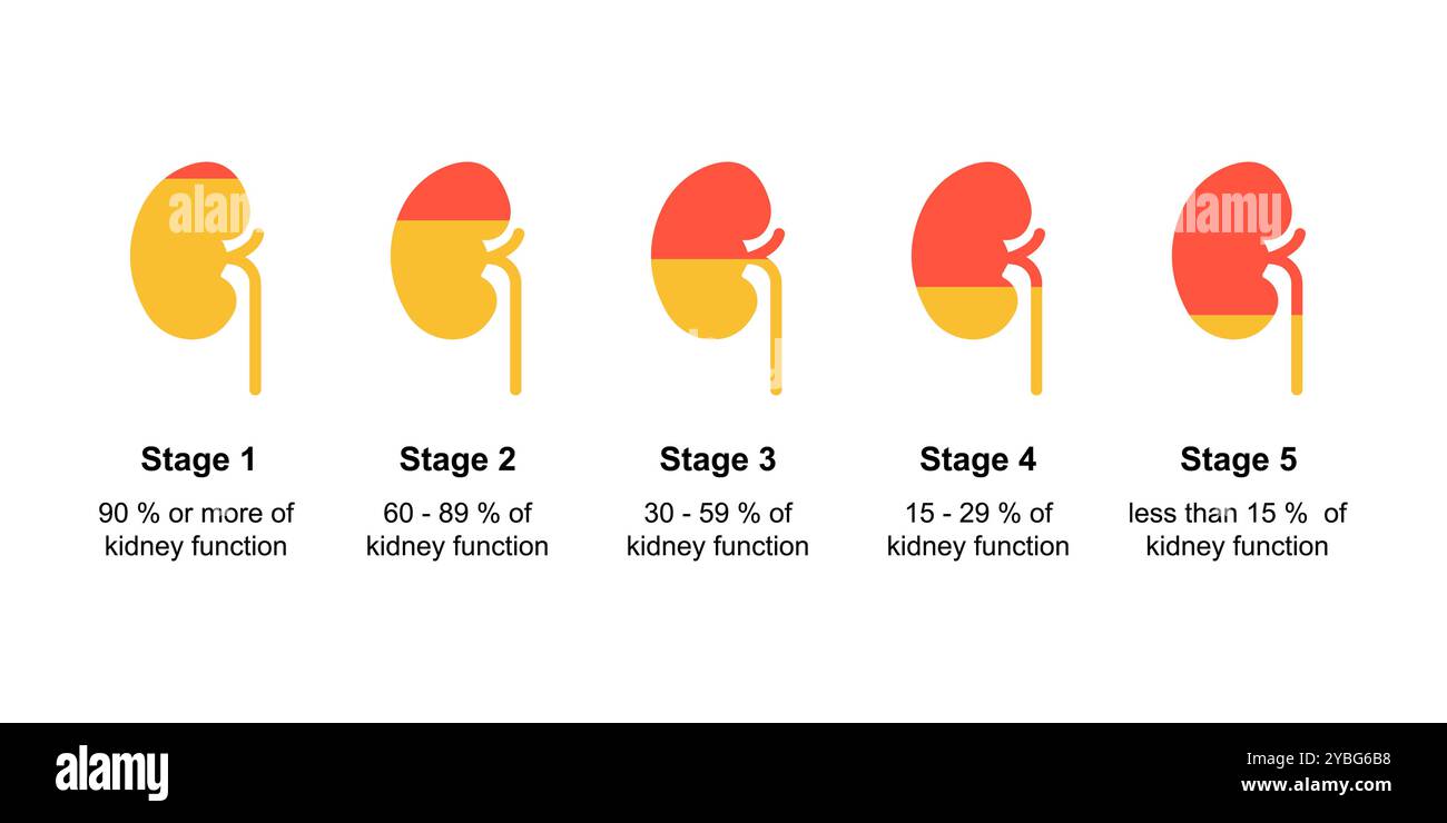 Chronic kidney disease stages, illustration Stock Photo - Alamy