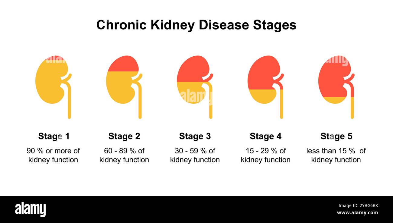 Chronic kidney disease stages, illustration Stock Photo - Alamy