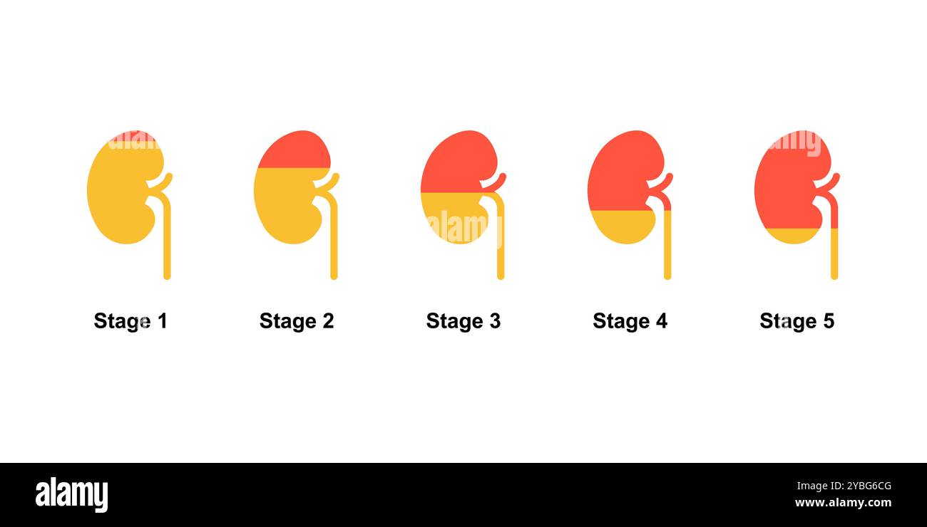 Chronic kidney disease stages, illustration Stock Photo - Alamy