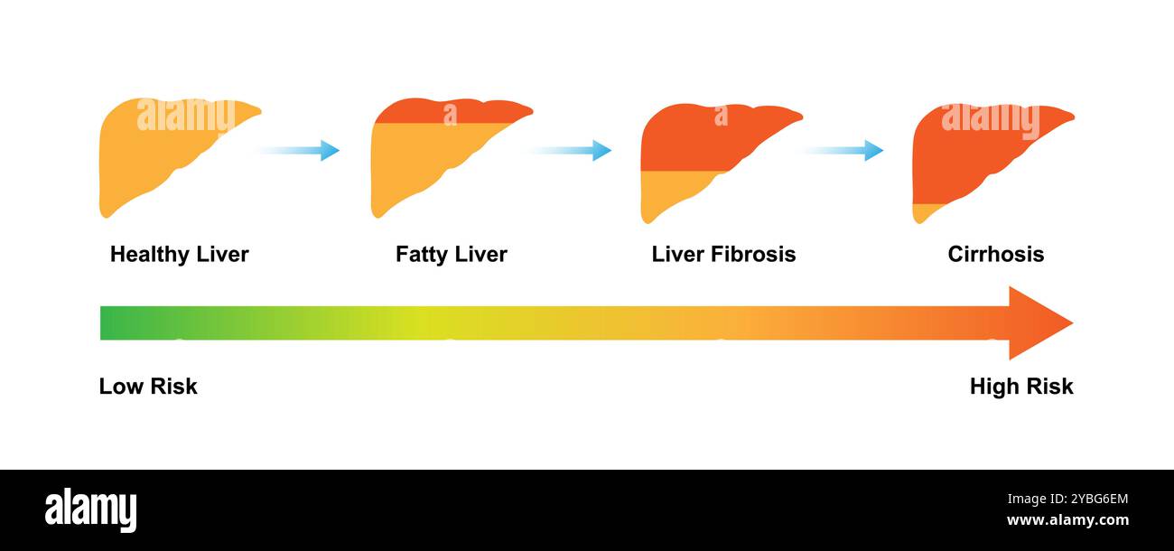 Stages of liver disease, illustration Stock Photo - Alamy