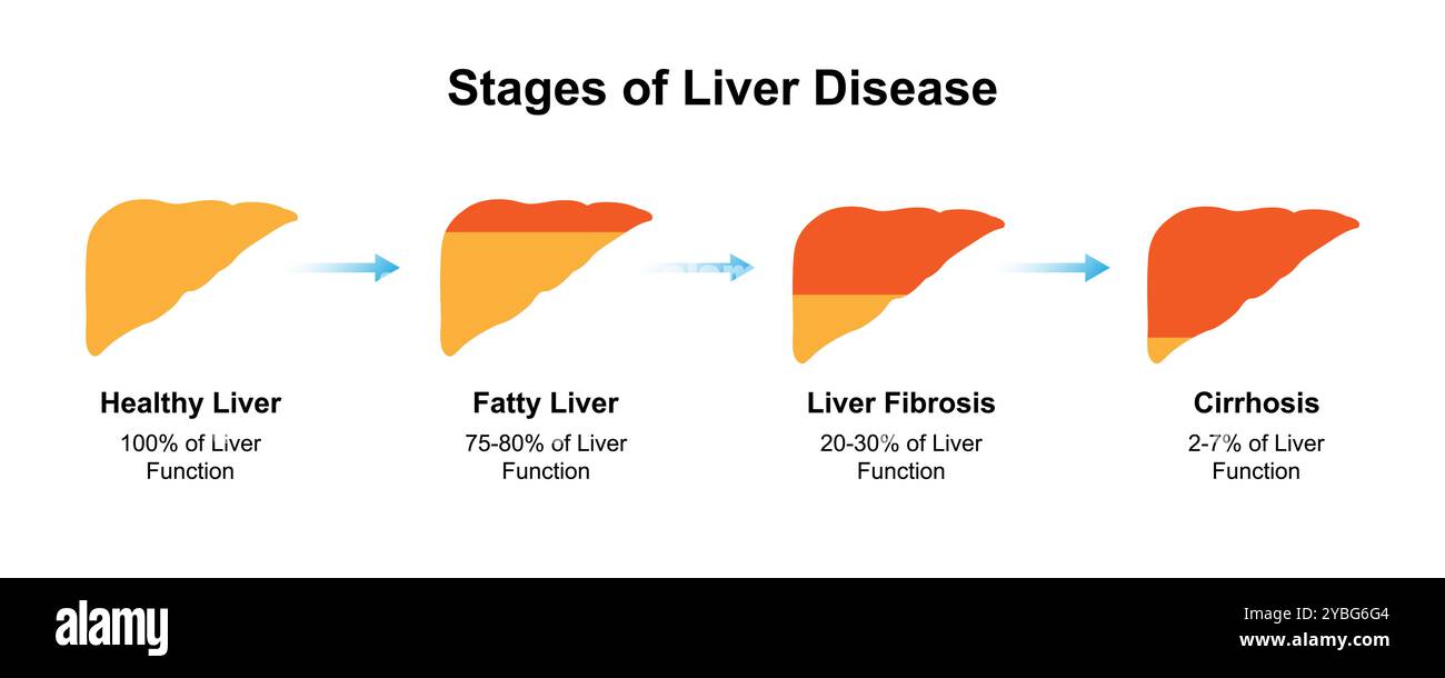 Stages of liver disease, illustration Stock Photo - Alamy