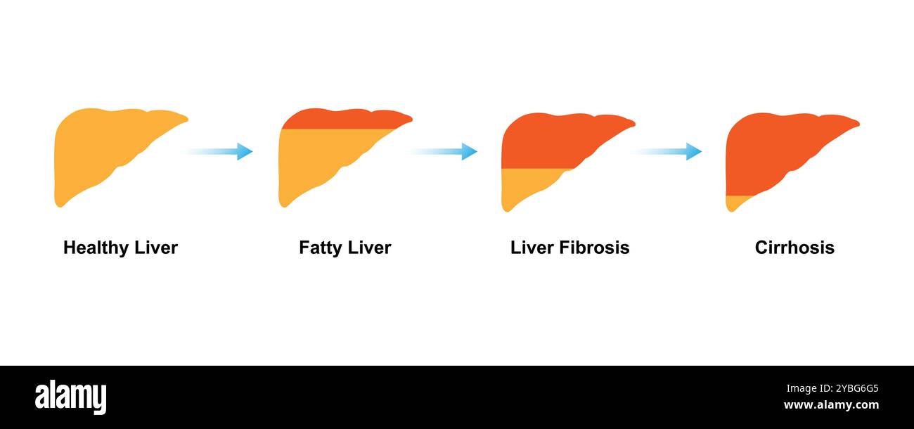 Stages of liver disease, illustration Stock Photo - Alamy