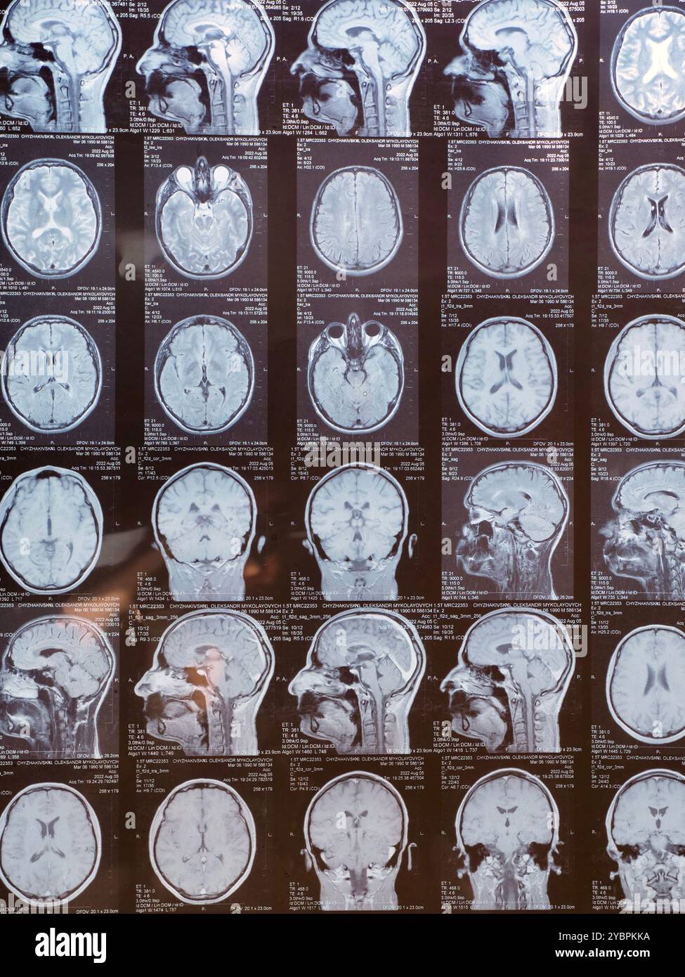 MRI of the human brain of a patient with multiple sclerosis of the ...