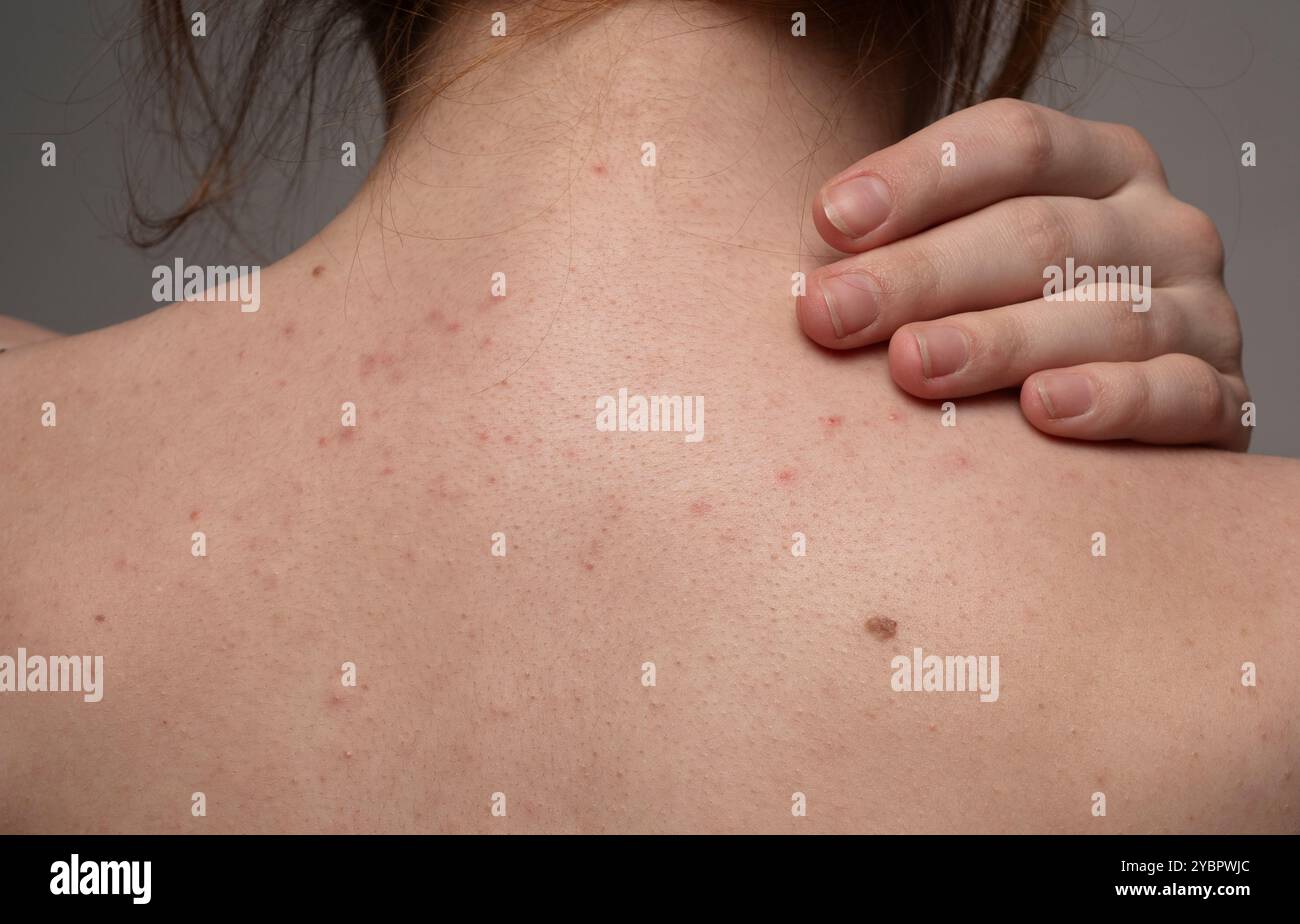 Dermatology problems. Health problem, skin diseases. Back with acne ...