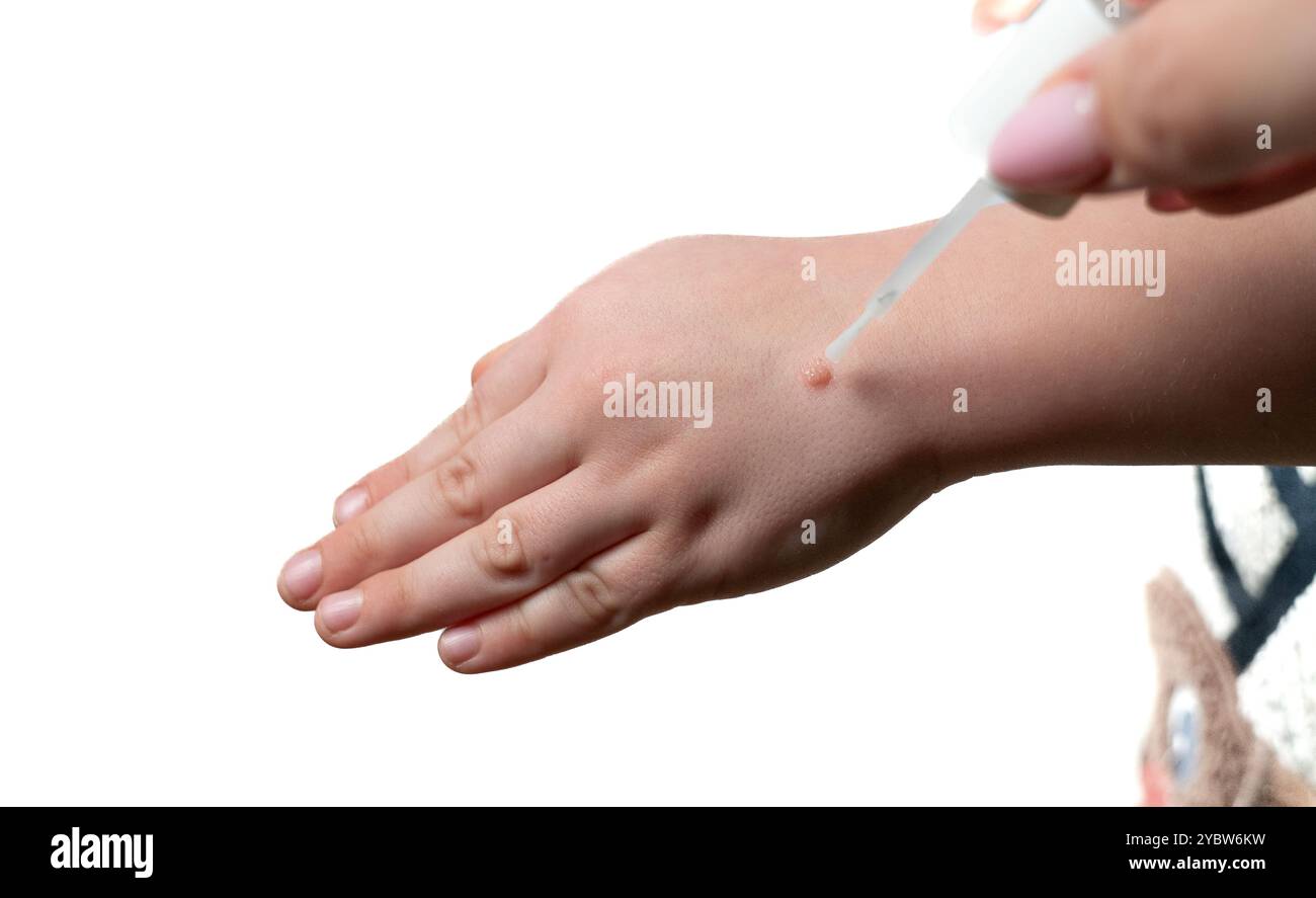 Verruca, HPV, human papilloma virus, wart - child catches verruca, kid ...