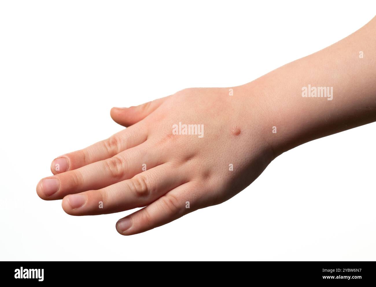 Wart freeze hi-res stock photography and images - Alamy