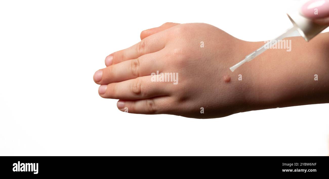 Verruca, HPV, human papilloma virus, wart - child catches verruca, kid ...