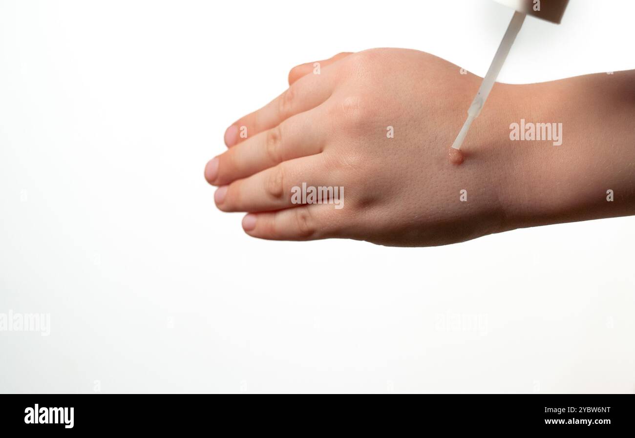 Verruca, HPV, human papilloma virus, wart - child catches verruca, kid ...