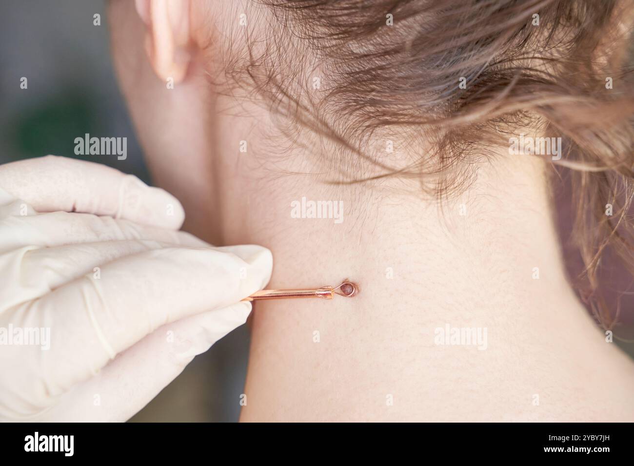 Woman examing her abnormal mole. Dermatology procedure. Doctor checking ...