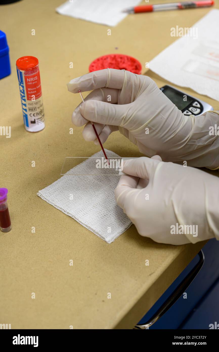 preparing a slide with a blood sample for examination, the blood on the ...
