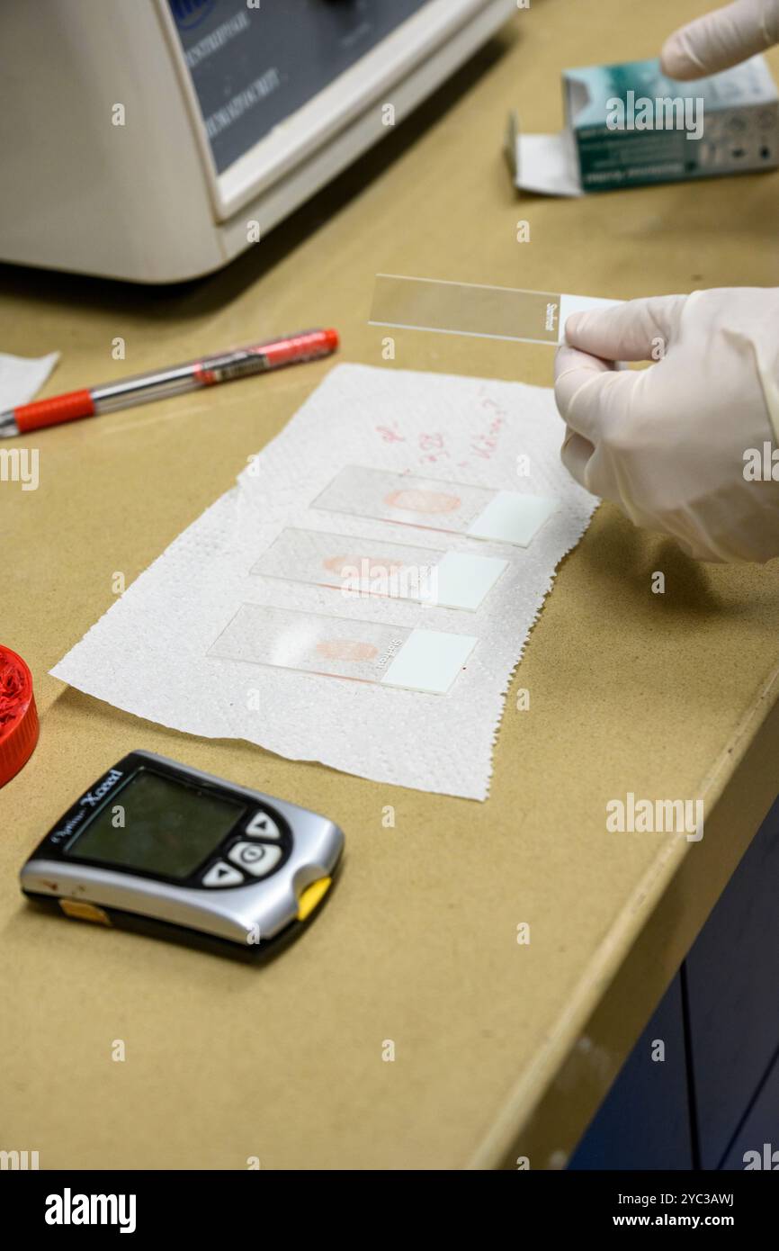preparing a slide with a blood sample for examination, the blood on the ...