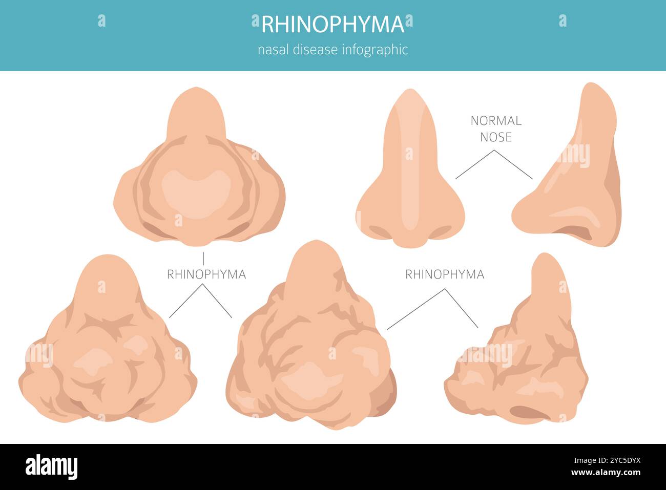 Rhinophyma. Nasal diseases. Medical infographic design. Vector ...