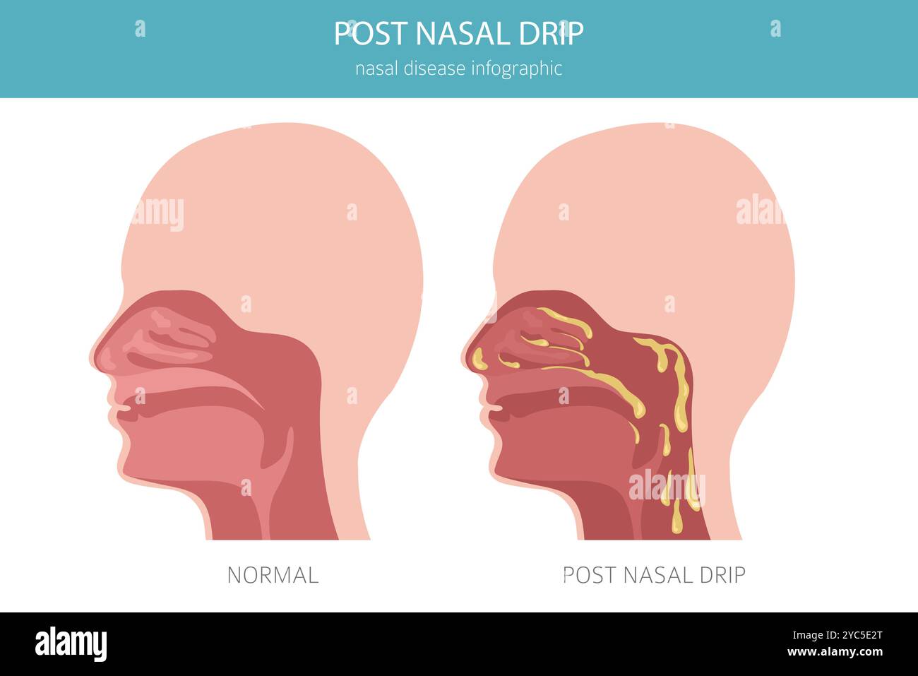 Post Nasal Drip Nasal Diseases Medical Infographic Design Vector