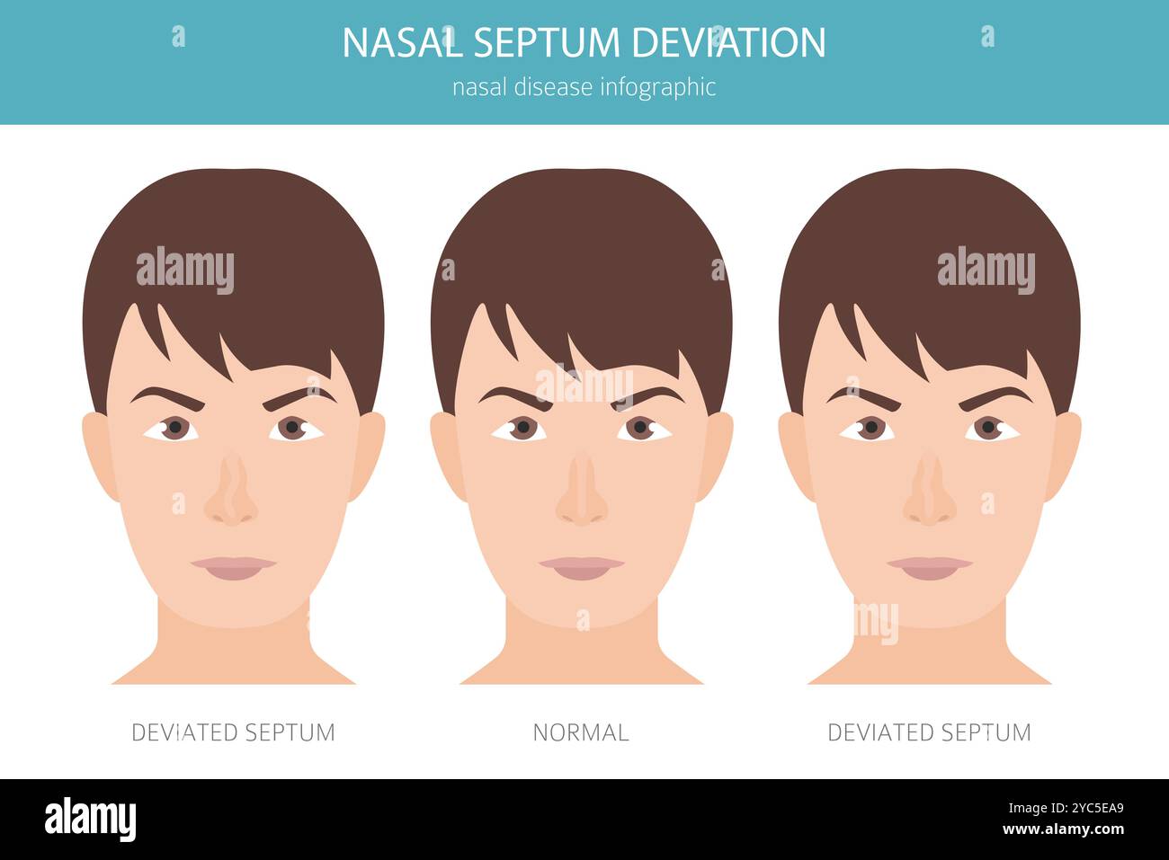 Deviated septum hi-res stock photography and images - Alamy