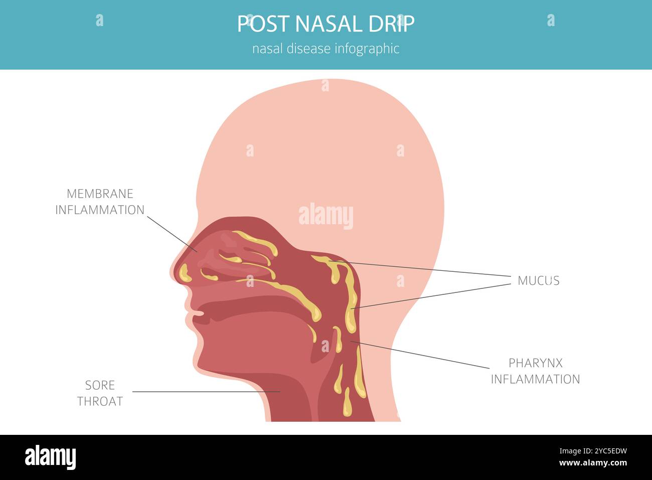 Post Nasal Drip Nasal Diseases Medical Infographic Design Vector